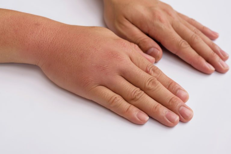 Dealing with a Swollen Hand After a Car Accident - The Accident Doctors